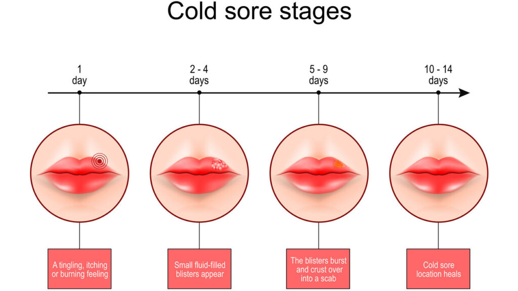 Cold Sores | Chesapeake Telemedicine